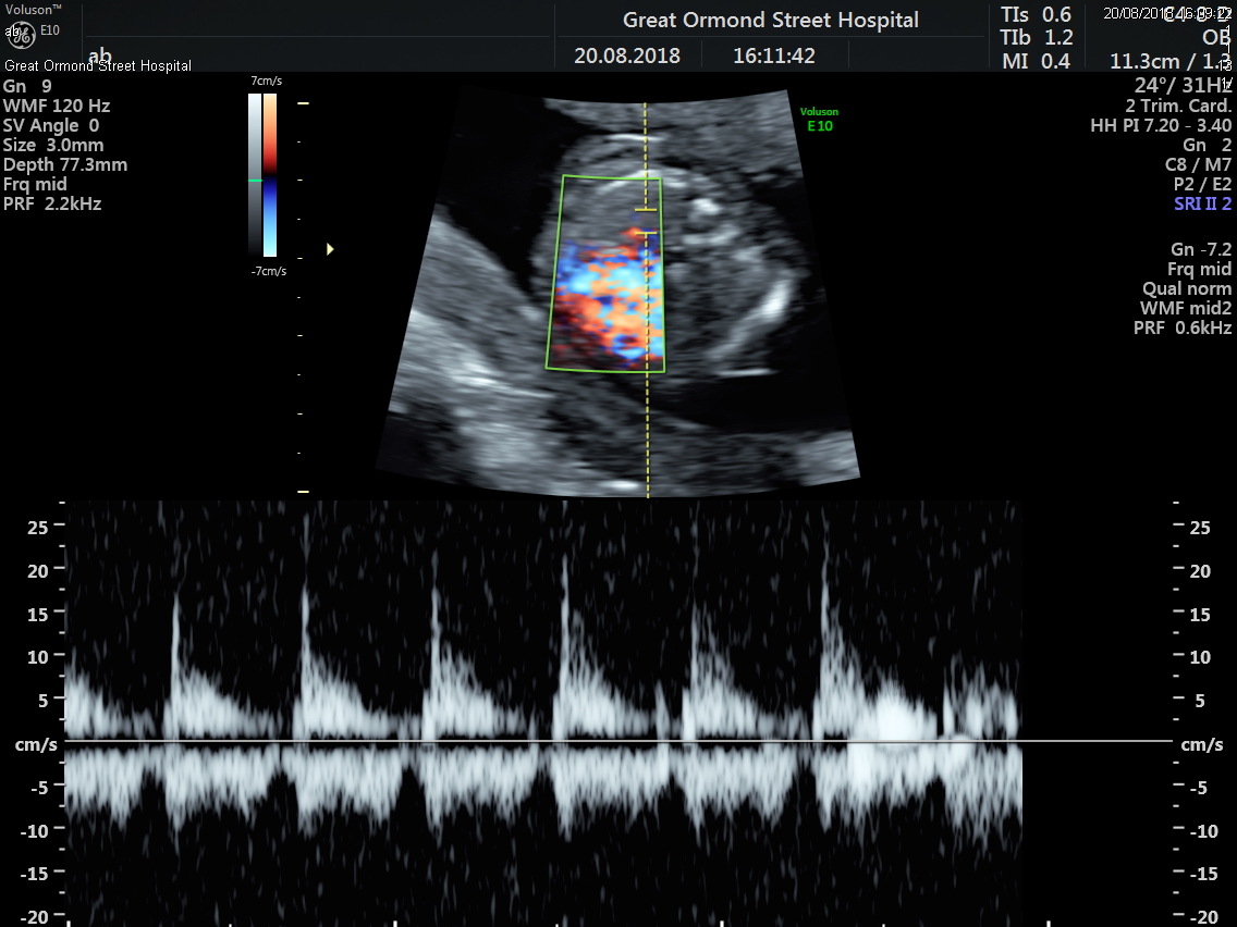 Fetal Cardiology Assessment | www.kidshearts.co.uk